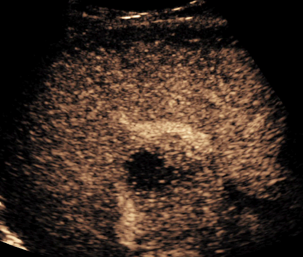 How Contrast Changed the Game for Liver Ultrasound in the US