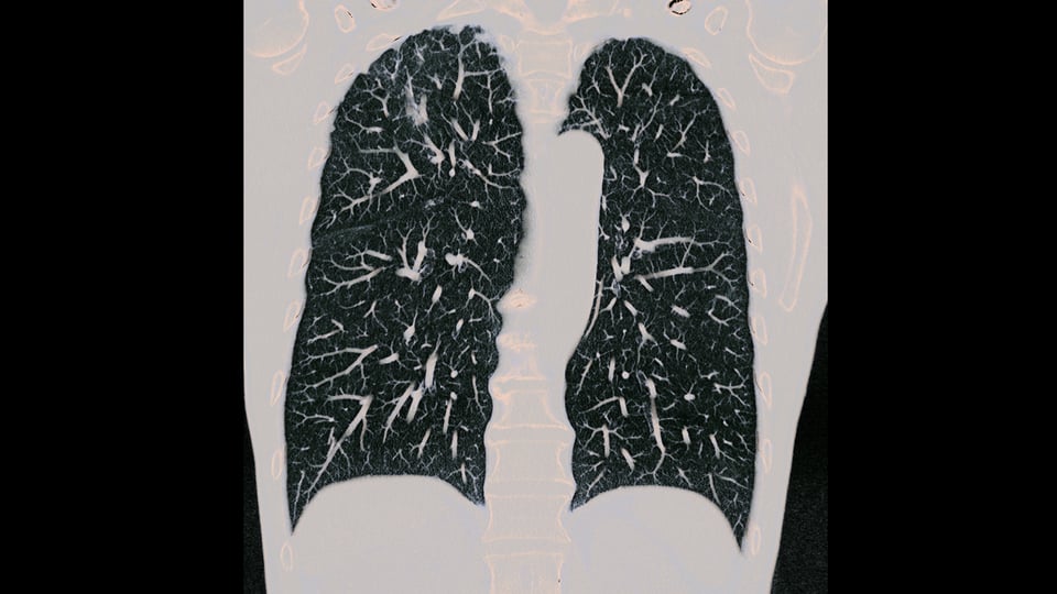 NAEOTOM Alpha Photon Counting CT System