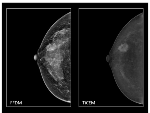 MAMMOMAT B.brilliant